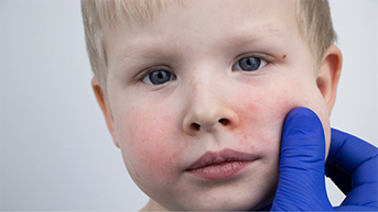 Virus Causes "Slapped Cheek" Syndrome | Kelsey-Seybold Clinic