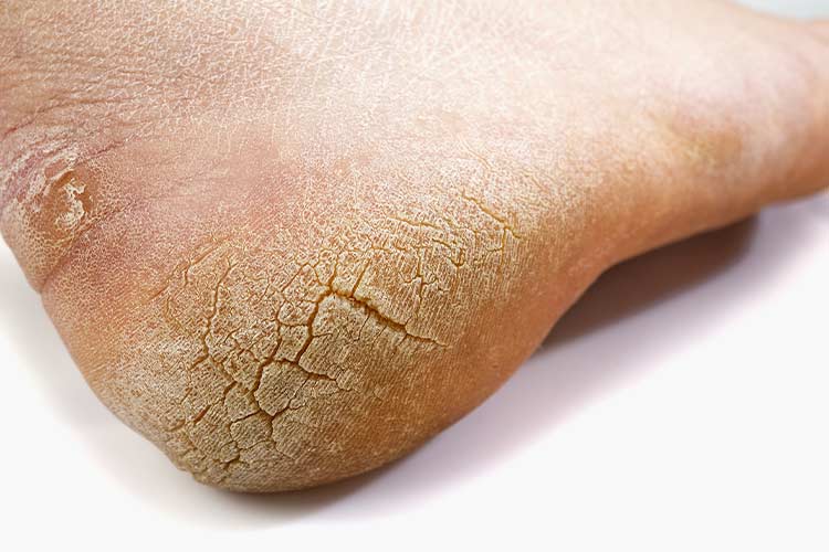 Bad Cracked Heels